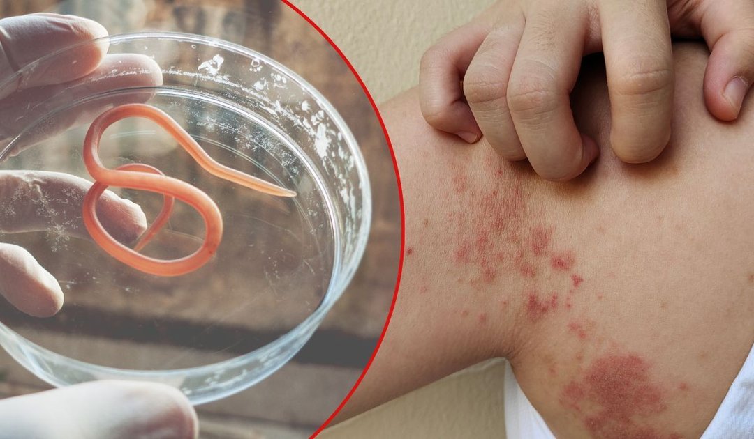 Czyrak - rozpoznanie, objawy, leczenie. Kiedy czyrak jest niebezpieczny?