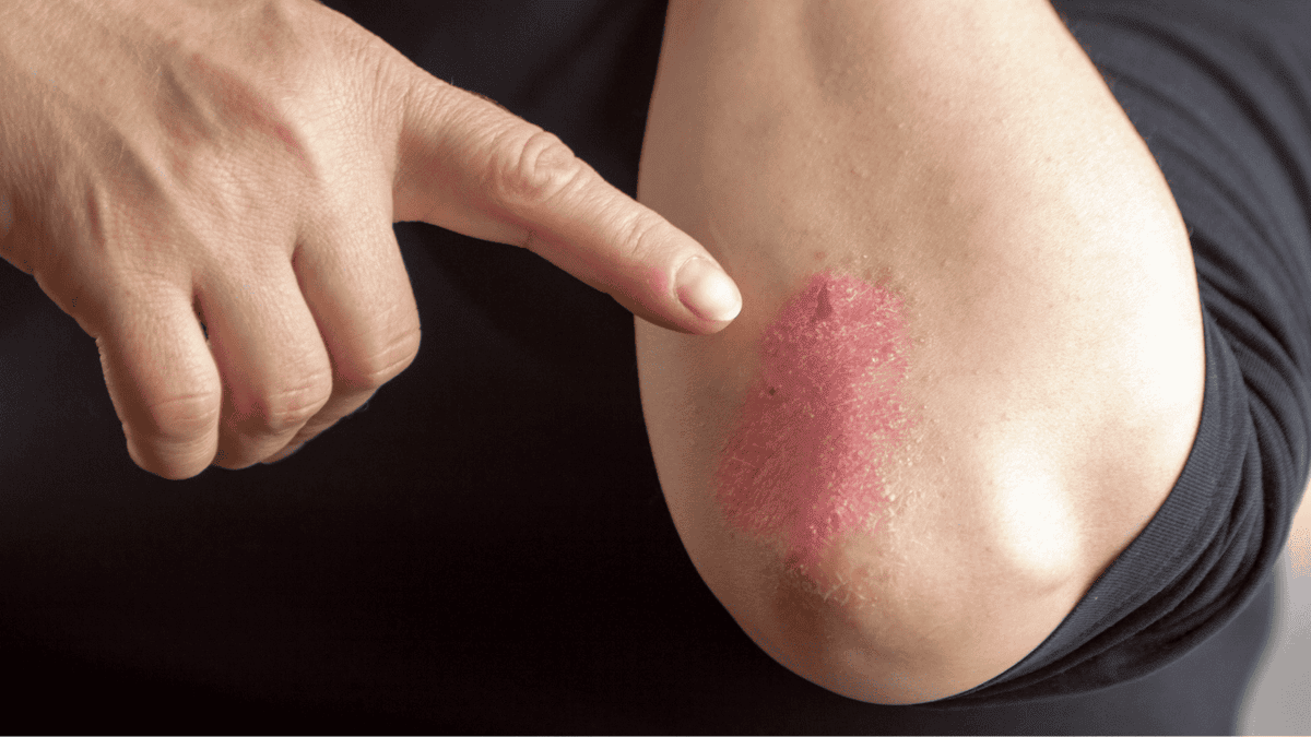 Swędzą Cię podeszwy stóp? To może być objaw choroby | Pacjenci