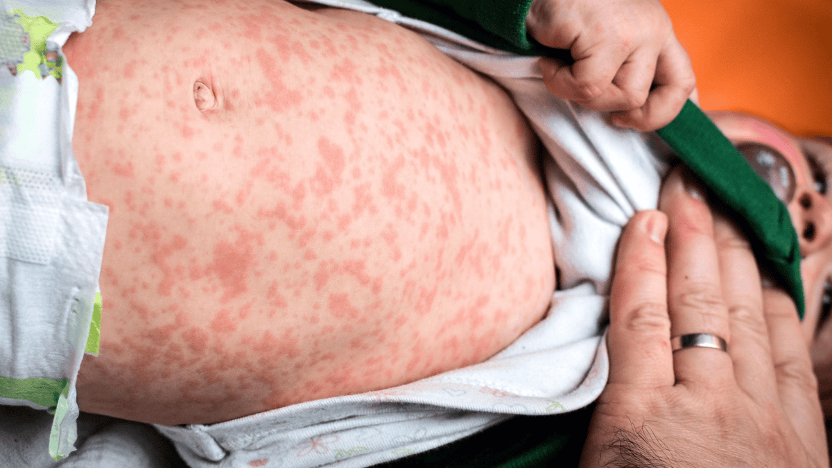 Odra – wraca zapomniana choroba. Jak się przed nią chronić?