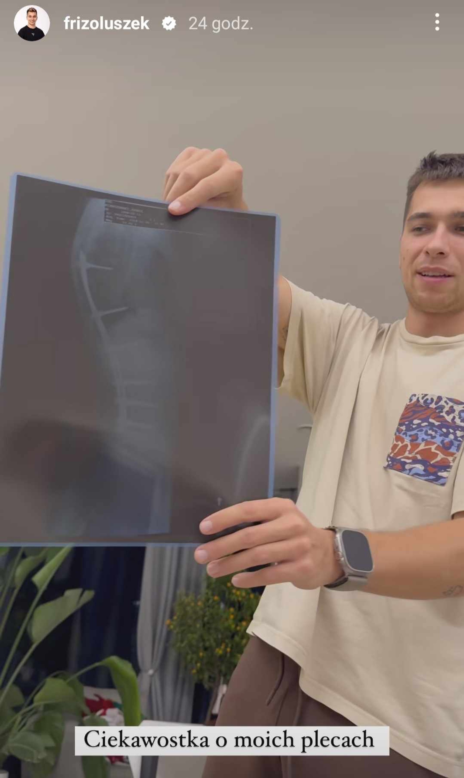 Friz o operacji kręgosłupa. Zdjęcia | Świat Gwiazd