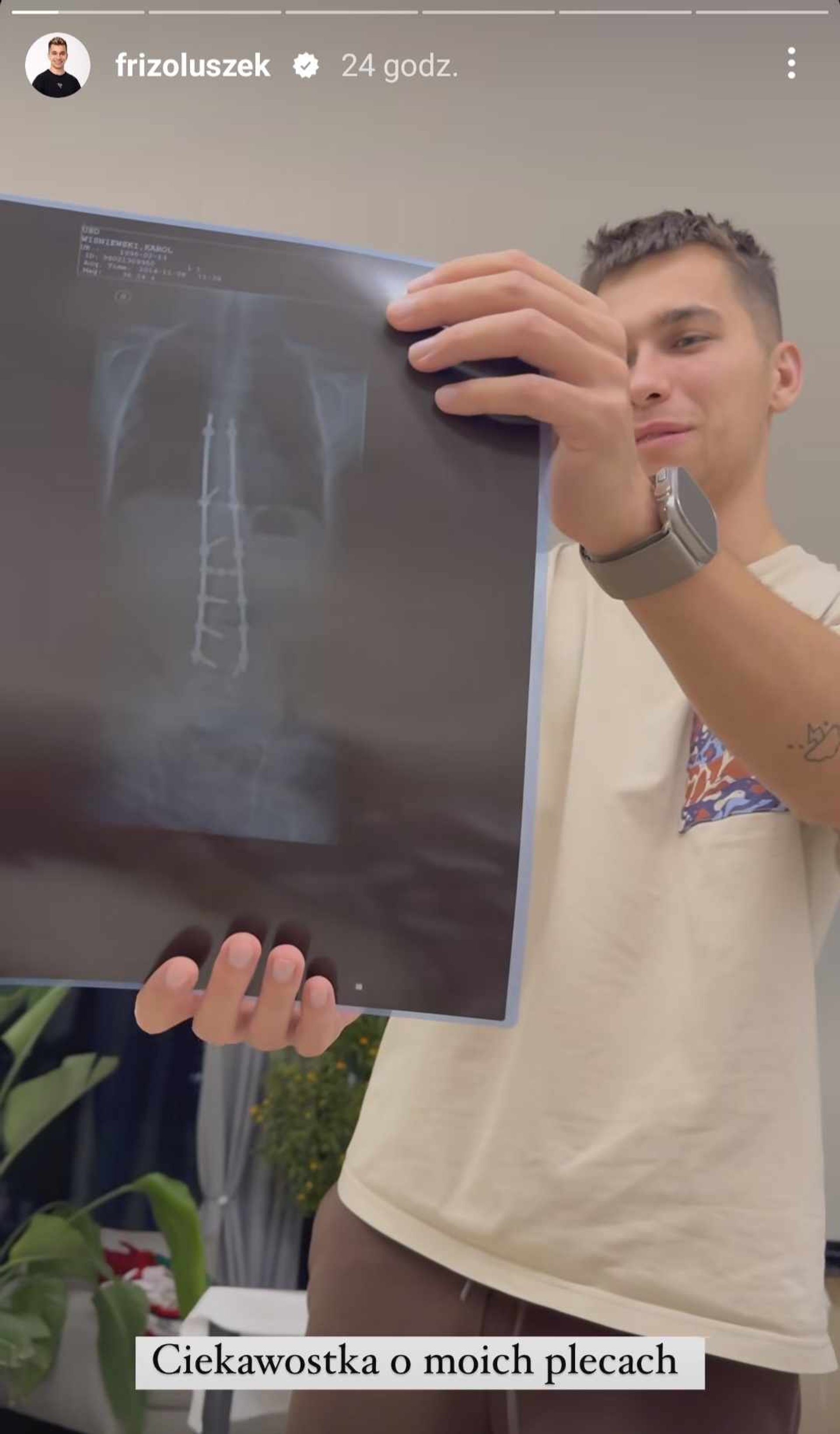 Friz o operacji kręgosłupa. Zdjęcia | Świat Gwiazd