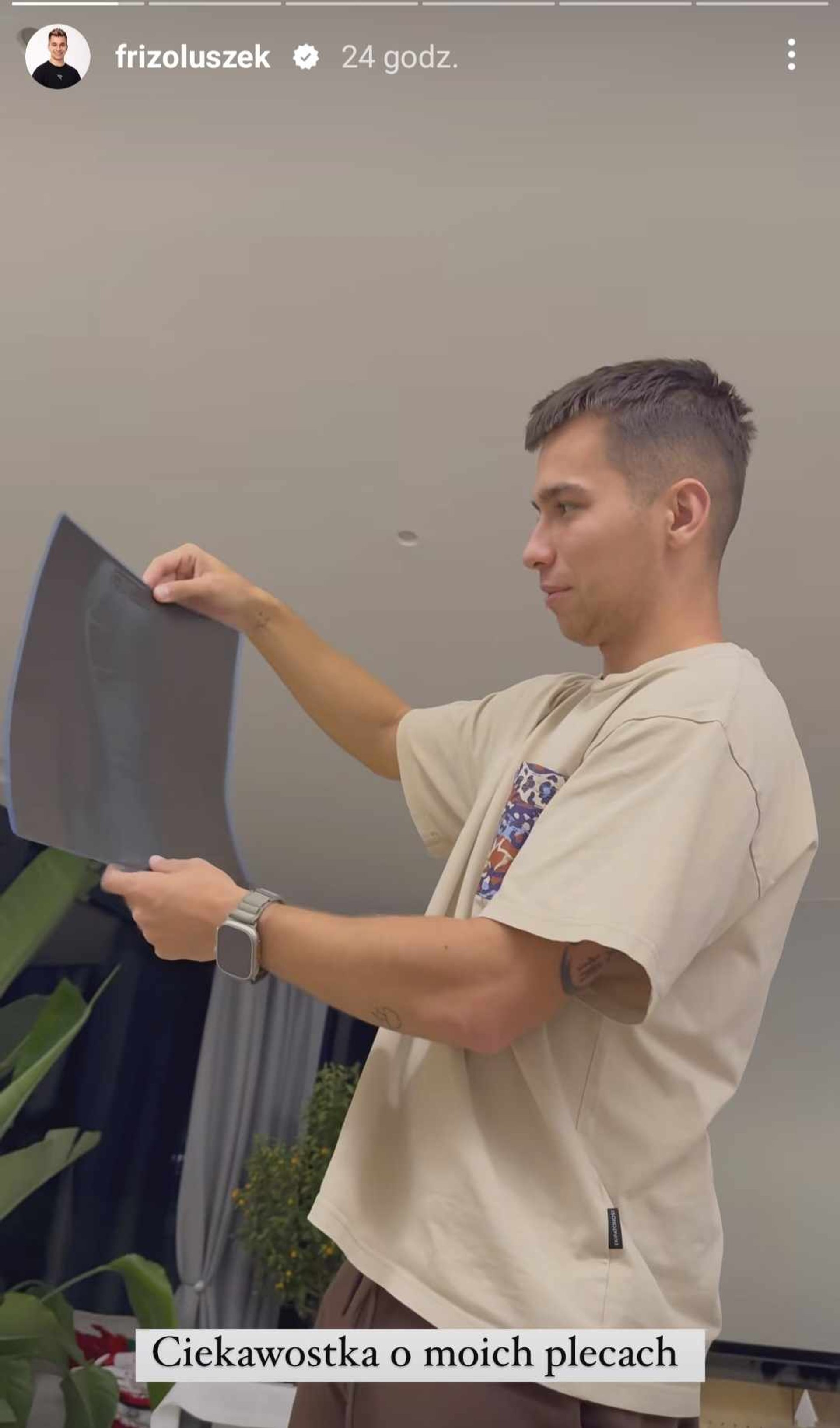 Friz o operacji kręgosłupa. Zdjęcia | Świat Gwiazd