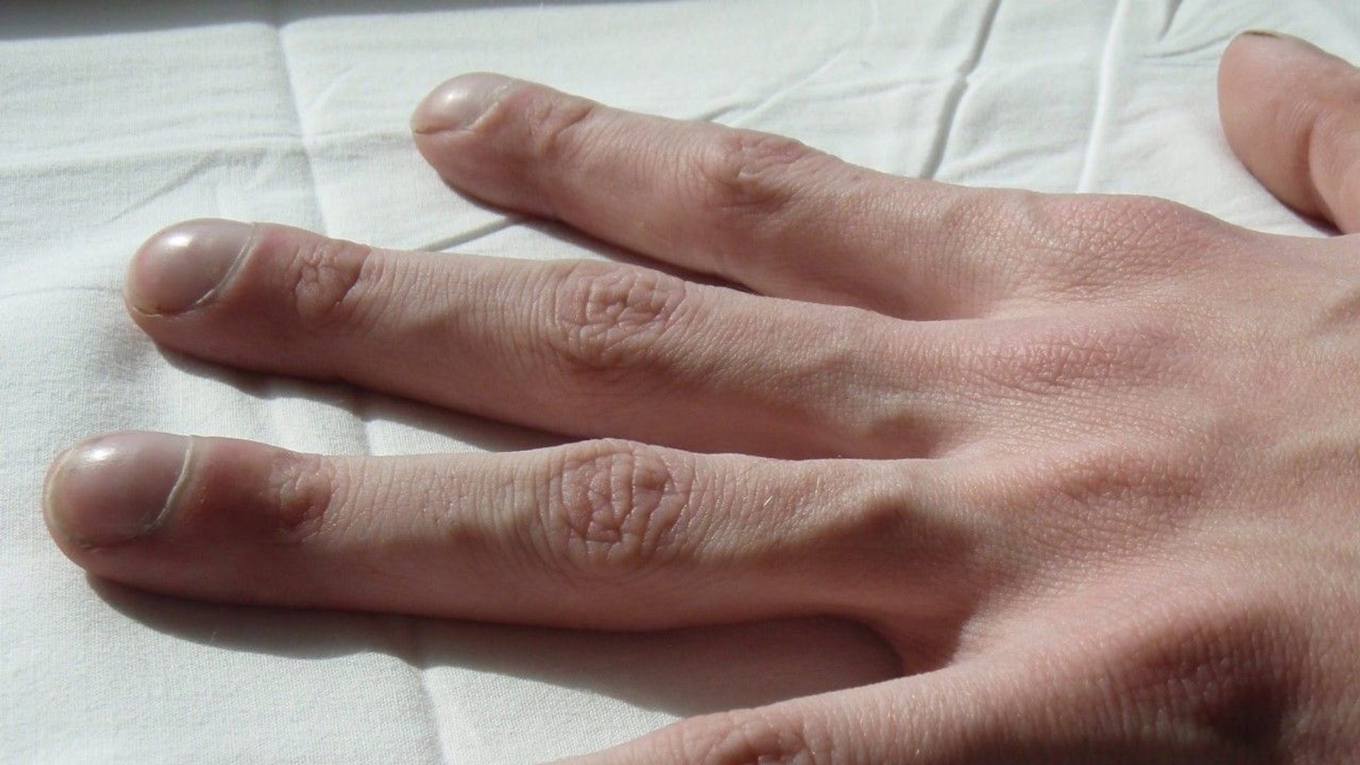 Takie palce mogą wskazywać na raka płuc. Lekarz opowiada o nietypowym ...