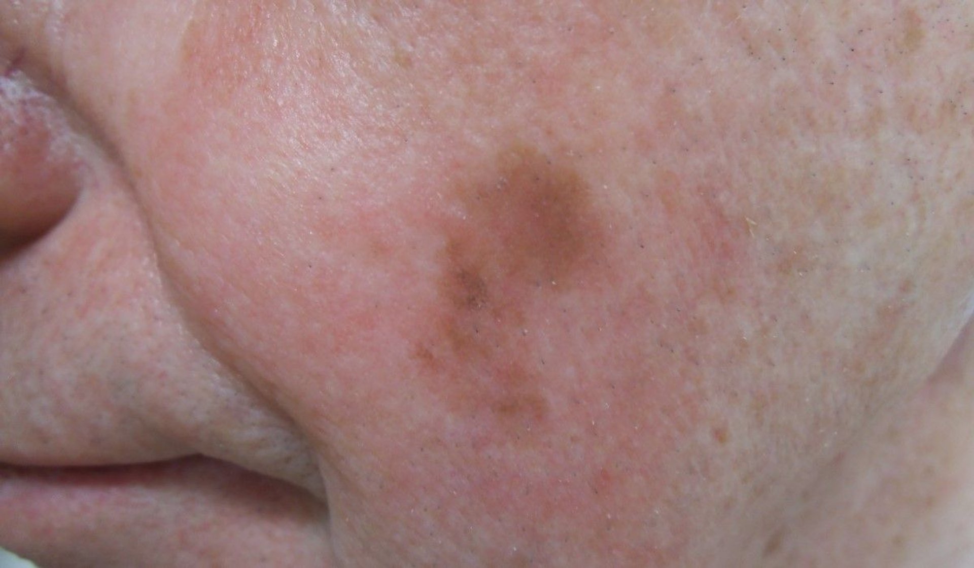 Czerniak – jak wygląda? Zdjęcia i opisy | Pacjenci