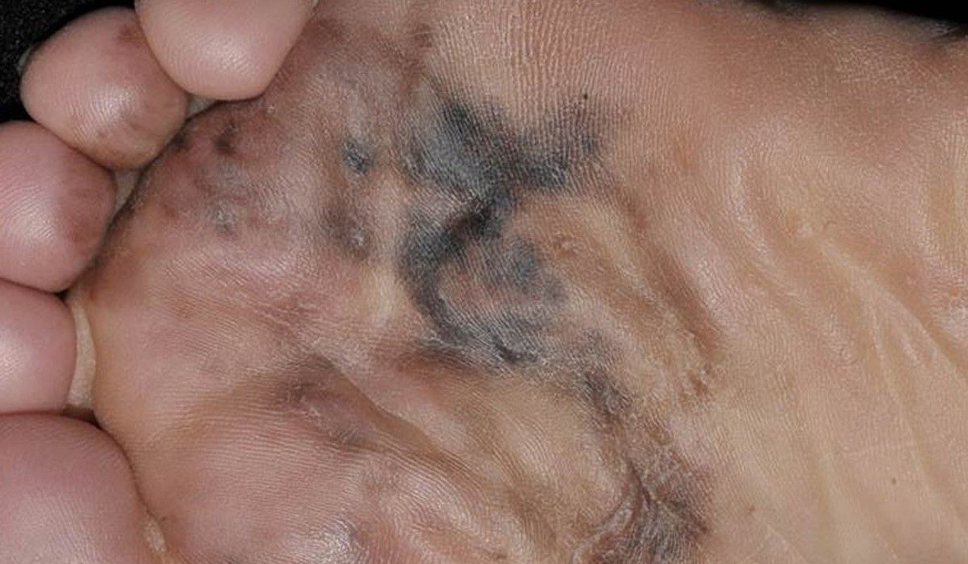 Czerniak – jak wygląda? Zdjęcia i opisy | Pacjenci