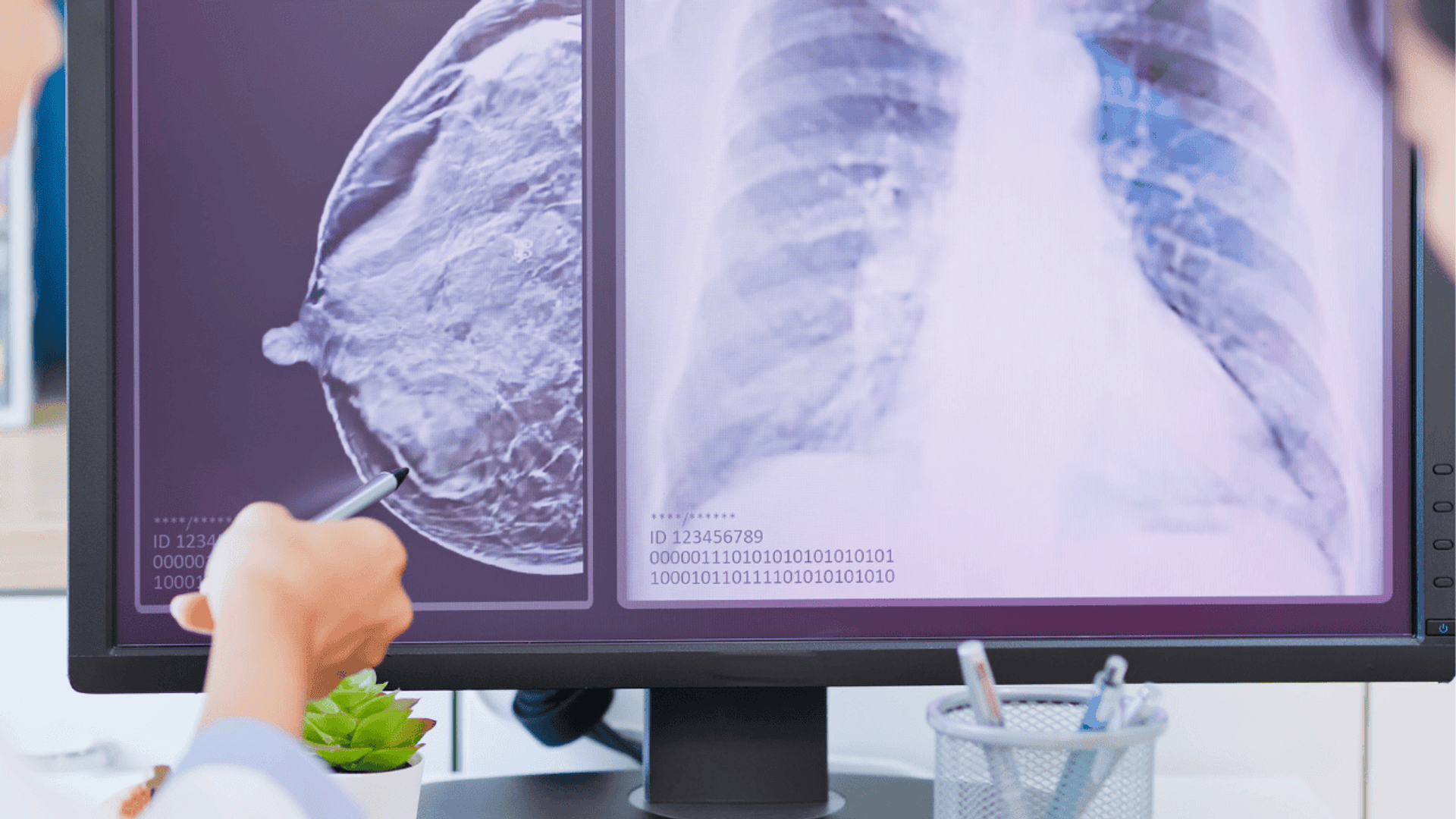 Rak piersi i przerzuty do kości. Najnowsze badania zespołu naukowców ...