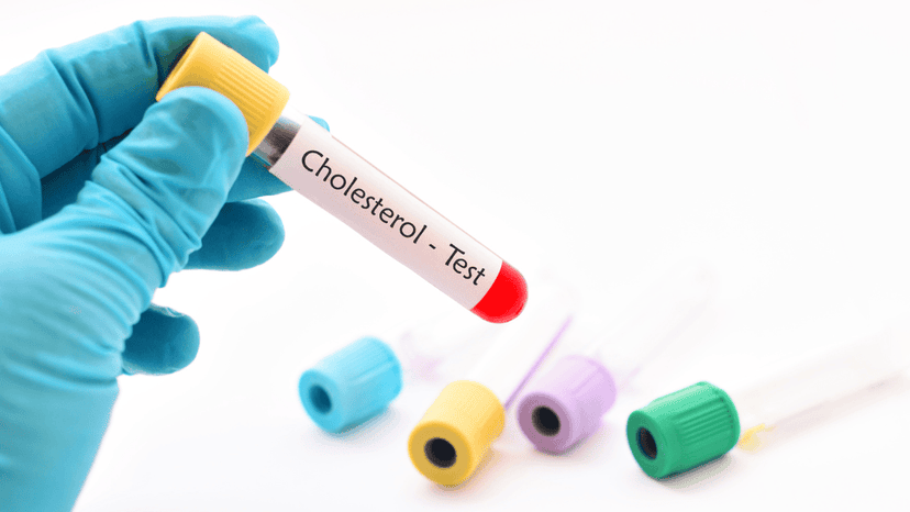 Po tym poznasz zbyt wysoki cholesterol. Jaki poziom cholesterolu we ...