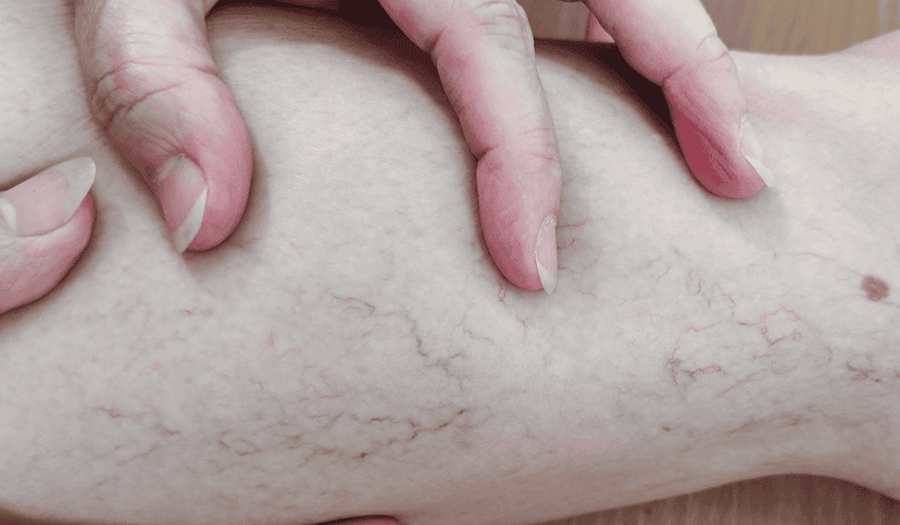 Błonica (dyfteryt) – przyczyny, objawy, leczenie, powikłania