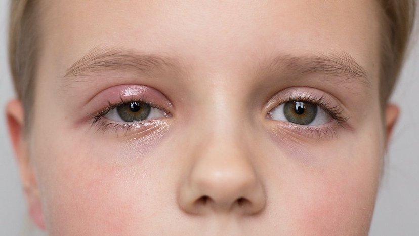 Czyrak - rozpoznanie, objawy, leczenie. Kiedy czyrak jest niebezpieczny?